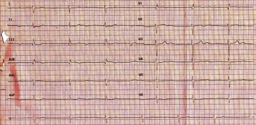 Figure 1: Electrocardiogram (ECG) on admission showing complete heart ...