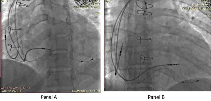 Figure 3: The location of the atrial and ventricular leads in Left ...